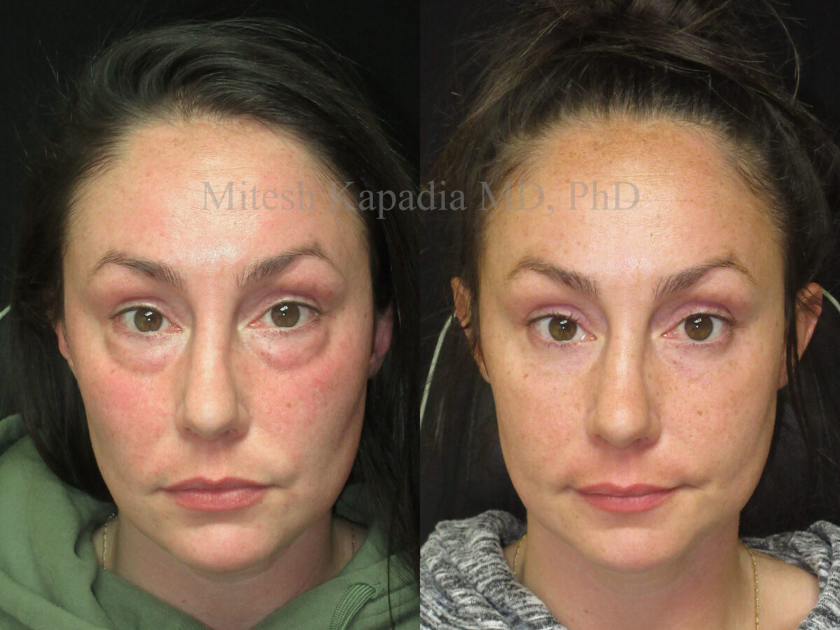 Lower Eyelid Surgery in Massachusetts | Boston Eyelid Surgery