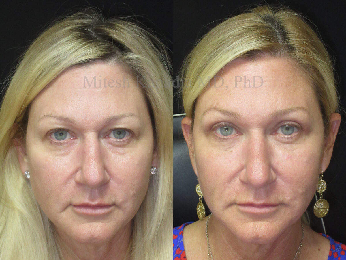 Before and six weeks after upper blepharoplasty surgery | Boston Eyelid ...