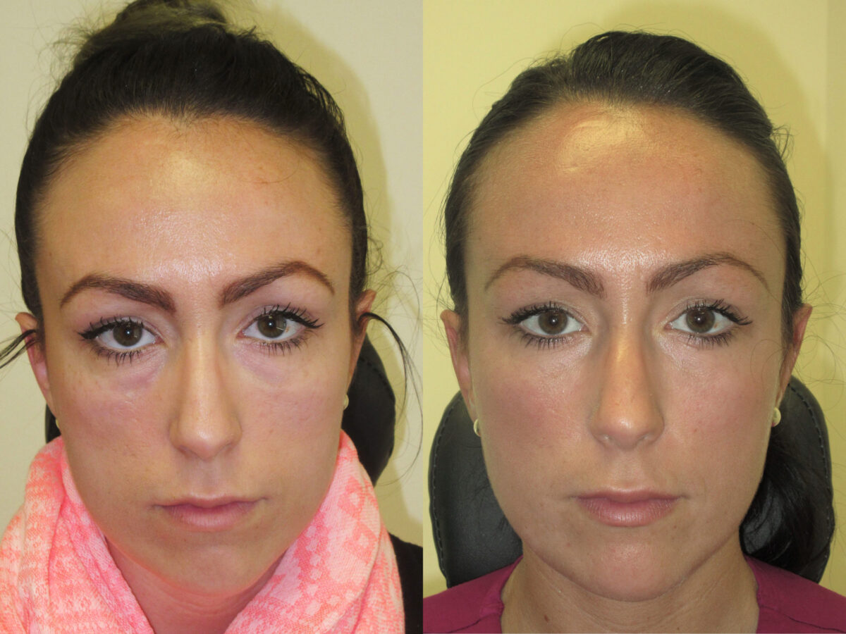 Before and after lower eyelid, midface and cheek fillers | Boston ...