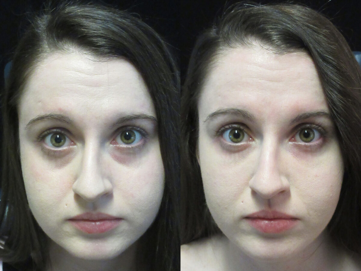 Before and three weeks after lower eyelid filler injections | Boston ...