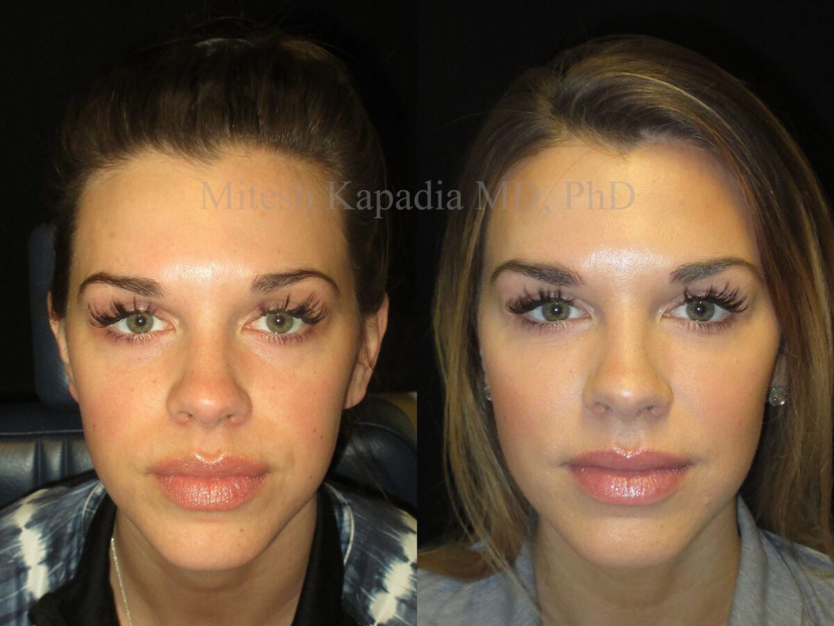 Cheek Augmentation | Boston Eyelid Surgery