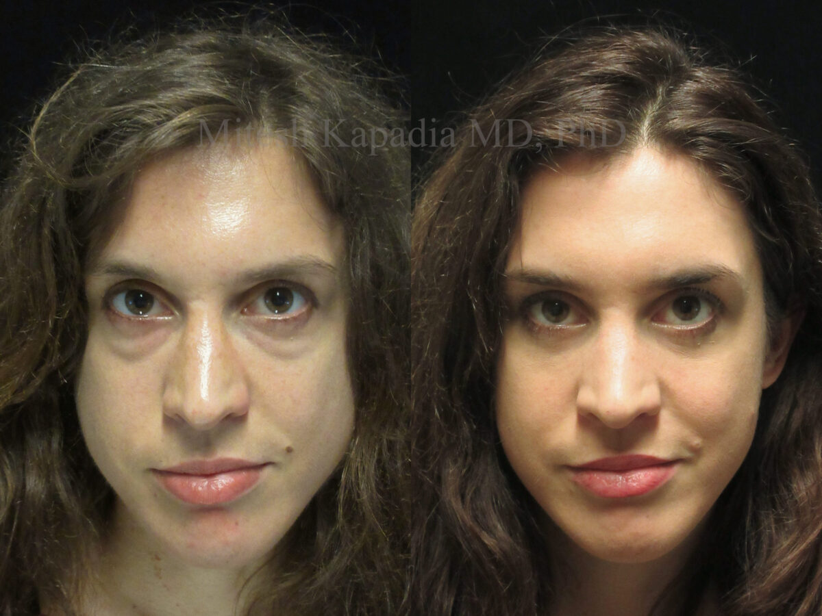 Botox Treatments | Boston Eyelid Surgery