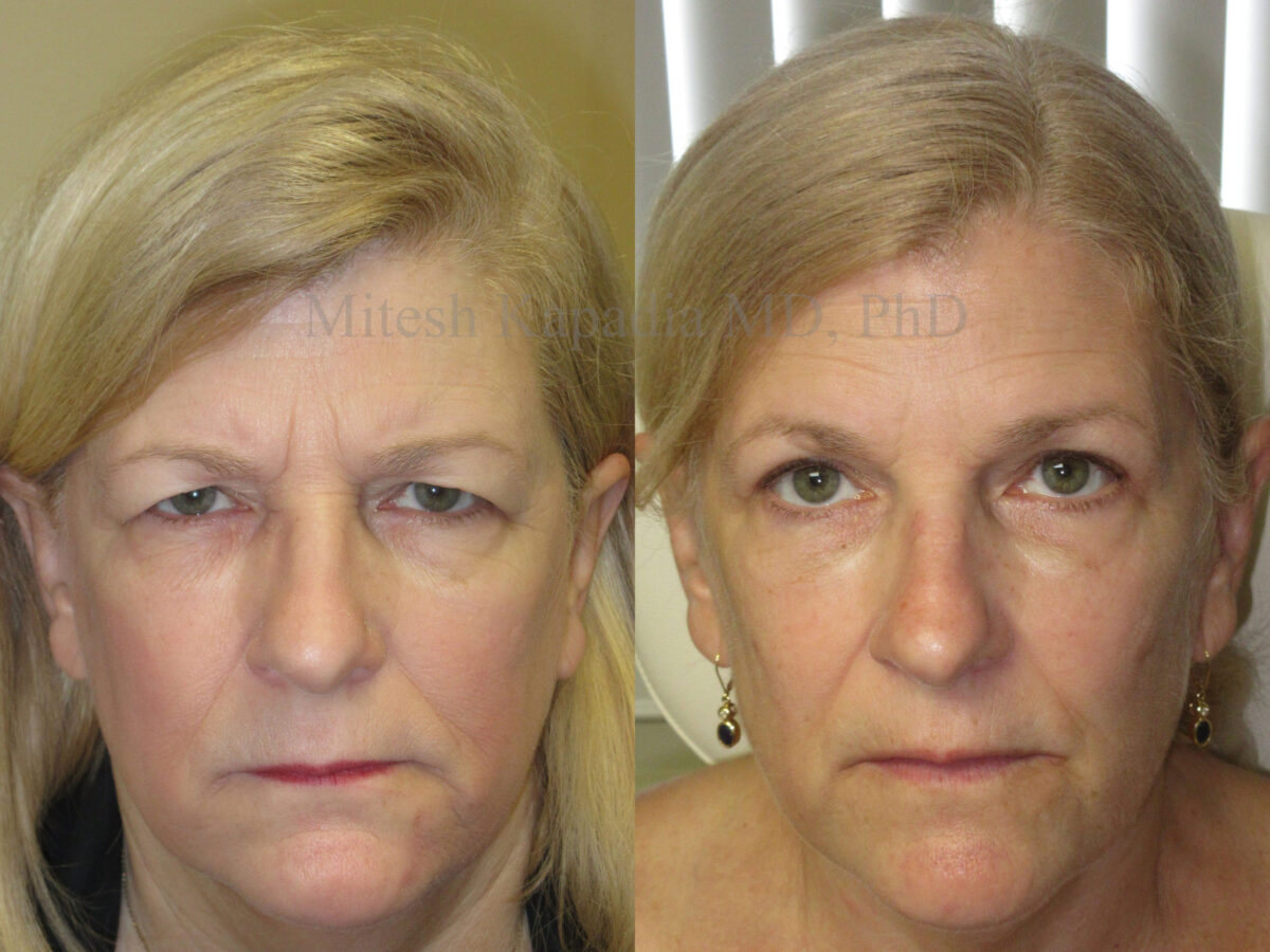 Before and four months after upper blepharoplasty surgery and one month ...