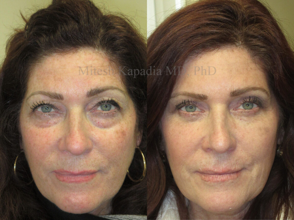 Before and six months after upper and lower blepharoplasty surgery | Boston Eyelid Surgery