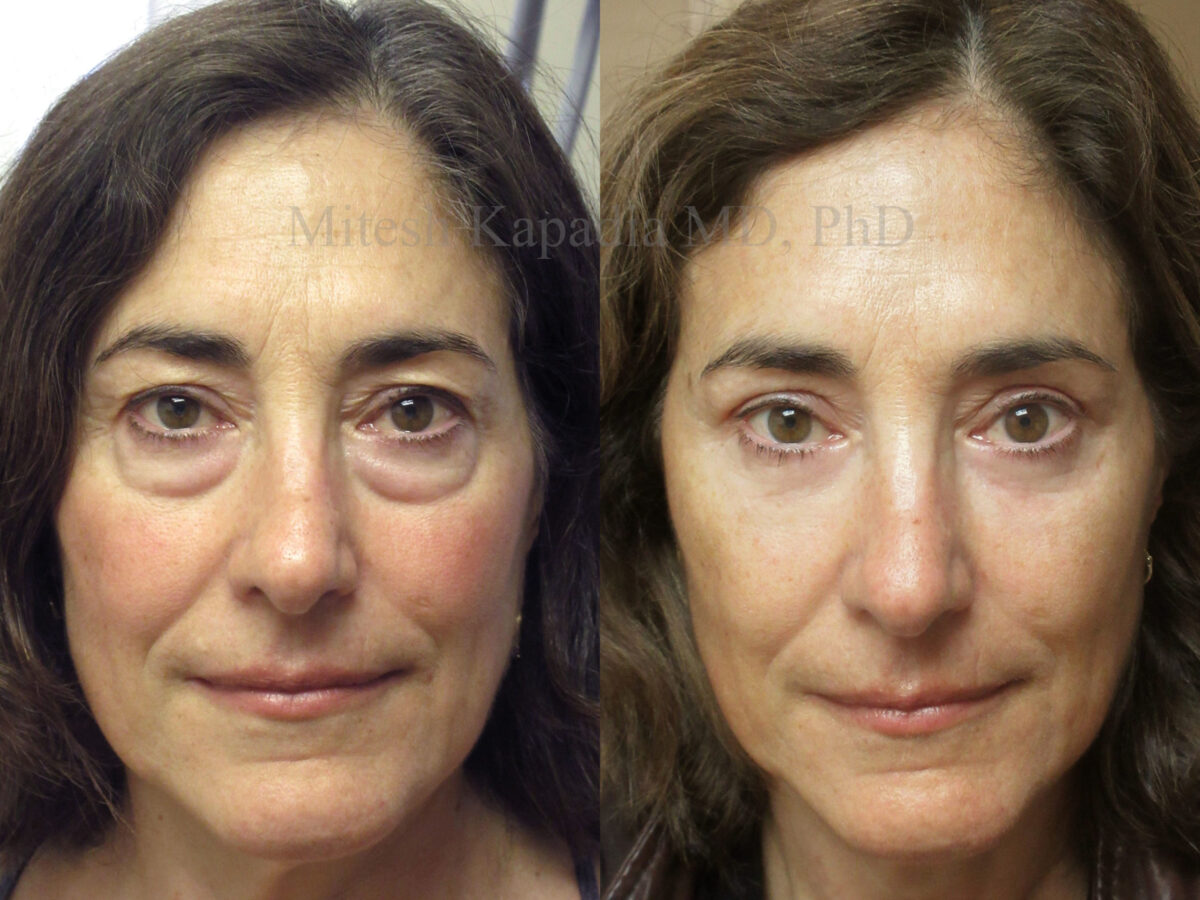 Upper and Lower Blepharoplasty | Boston Eyelid Surgery