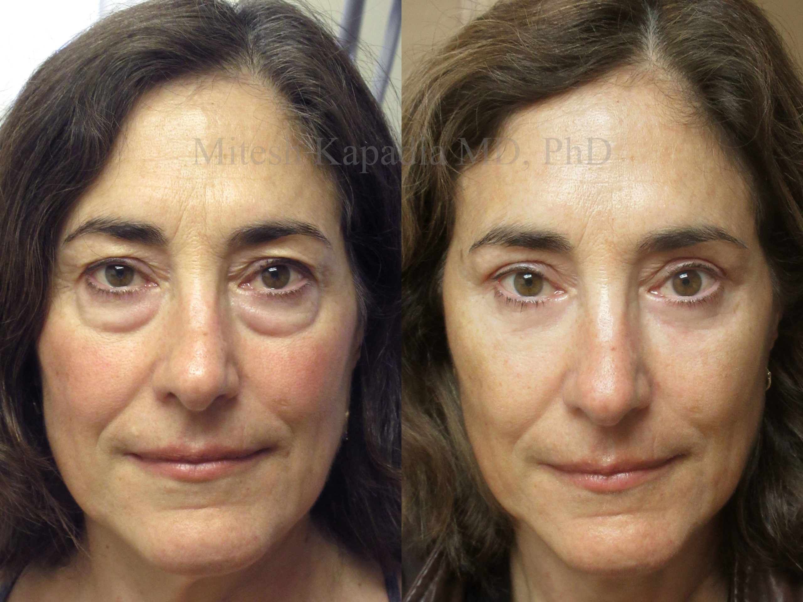 Upper And Lower Eyelid Surgery Before And After Photos You Infoupdate Upper And Lower Eyelid Surgery Before And After Photos You Infoupdate