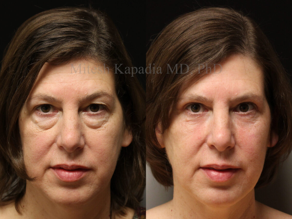 Before and three months after upper and lower blepharoplasty surgery and lower eyelid CO2 laser ...