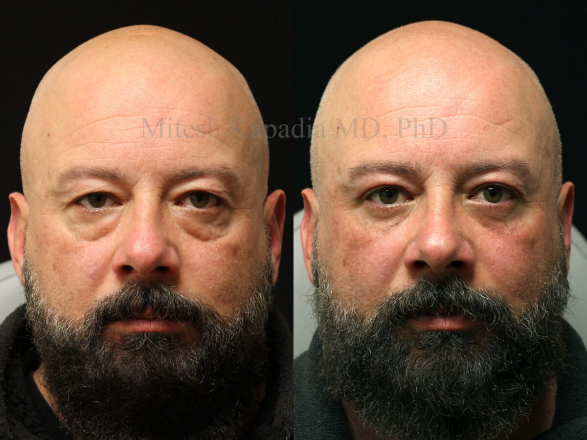 Ptosis Repair and Eyelid Retraction | Boston Eyelid Surgery