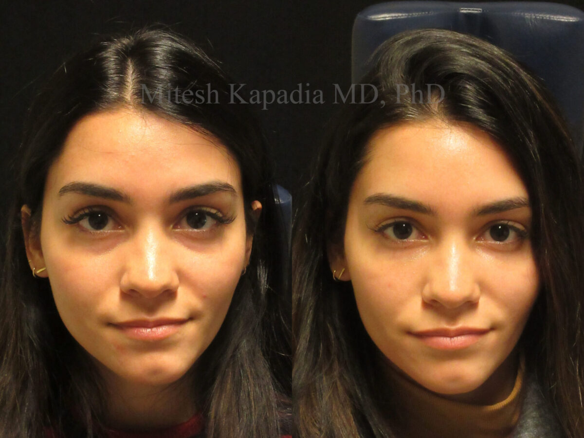 Before and three weeks after lower eyelid filler injections | Boston ...