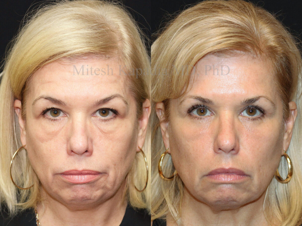 Festoons and Malar Bags | Boston Eyelid Surgery