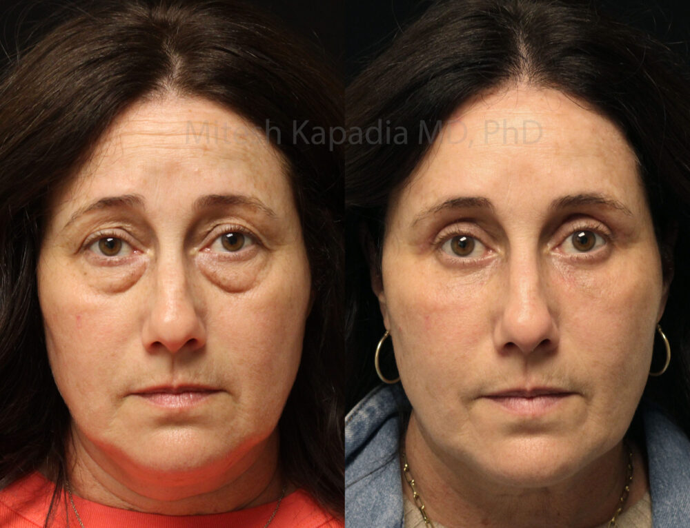 Before and after after CO2 laser skin resurfacing, two treatments ...