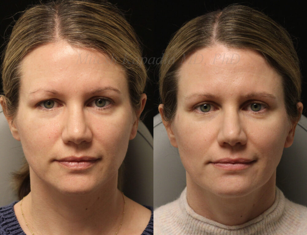 Before and two weeks after upper and lower blepharoplasty surgery | Boston Eyelid Surgery