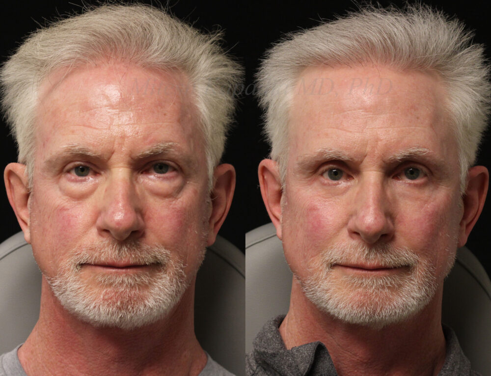 Before and six months after lower blepharoplasty surgery | Boston ...