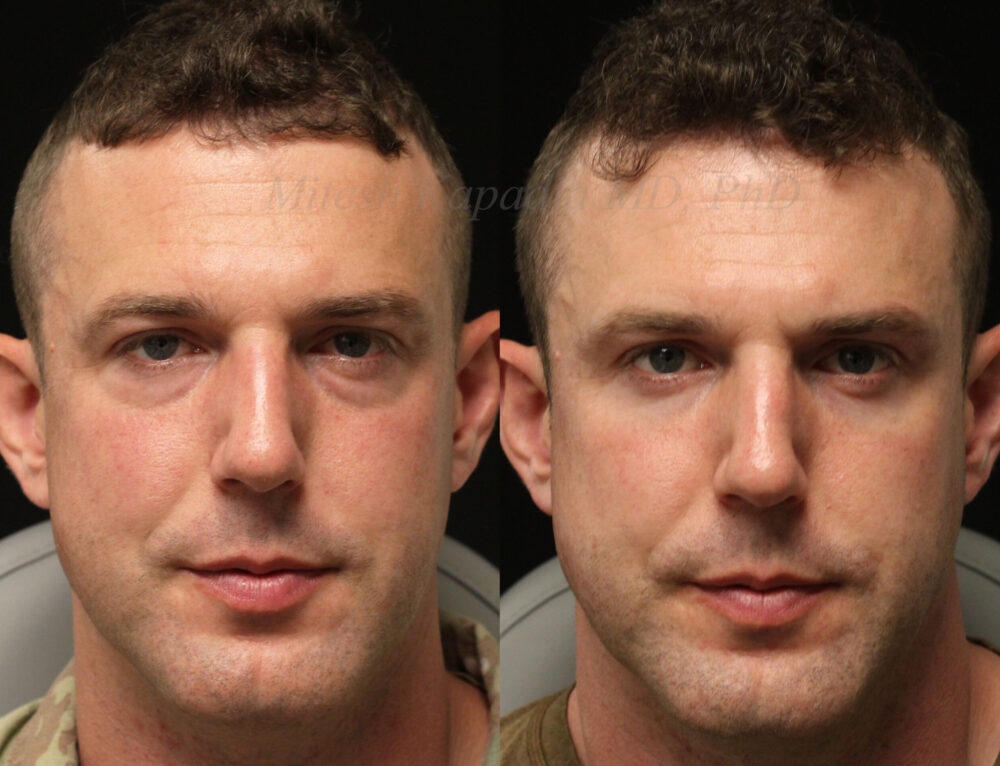 Before and four weeks after after upper and lower blepharoplasty ...