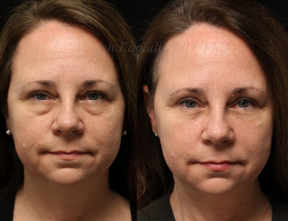 Before and six months after lower blepharoplasty surgery and lower ...