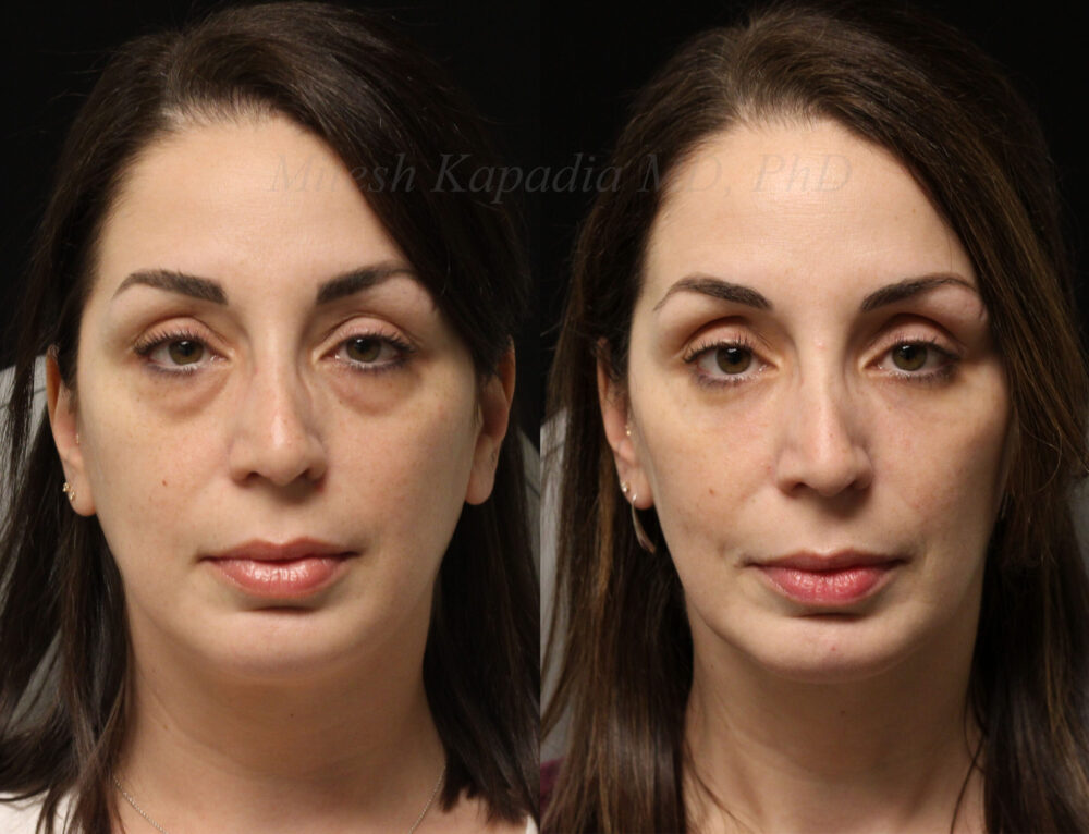 Before and two weeks after upper and lower blepharoplasty surgery ...