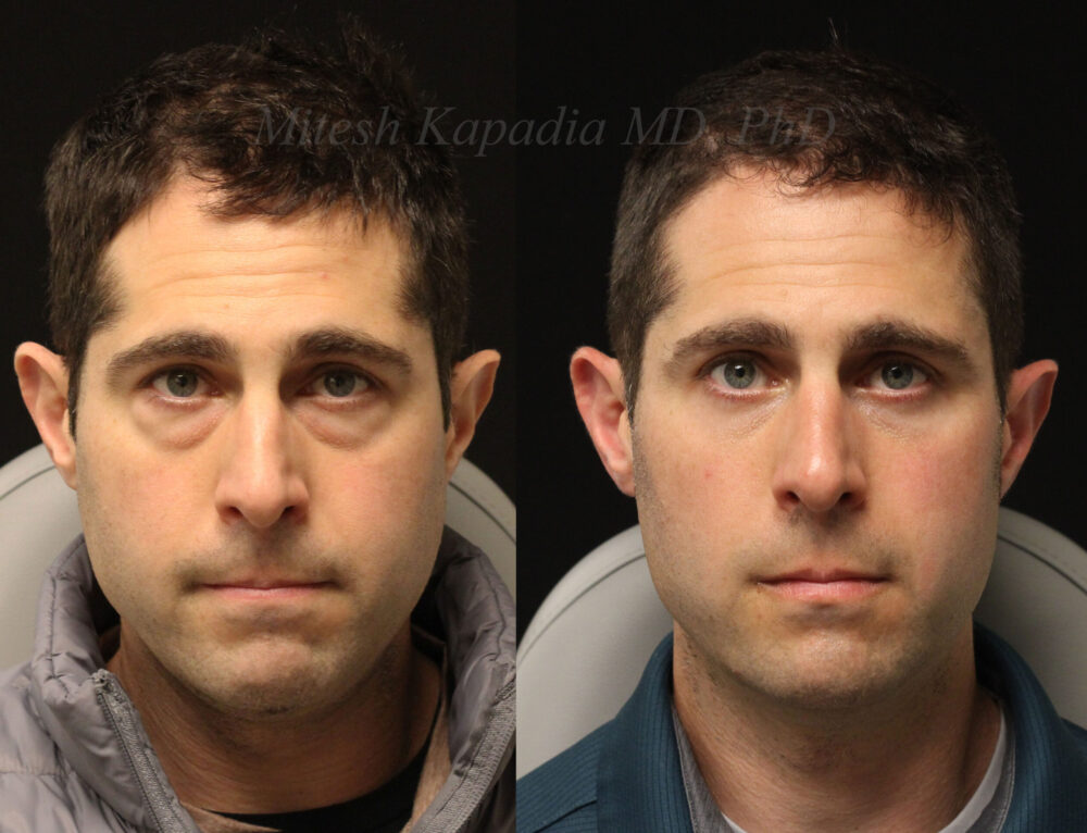 Before and four weeks after after upper and lower blepharoplasty ...