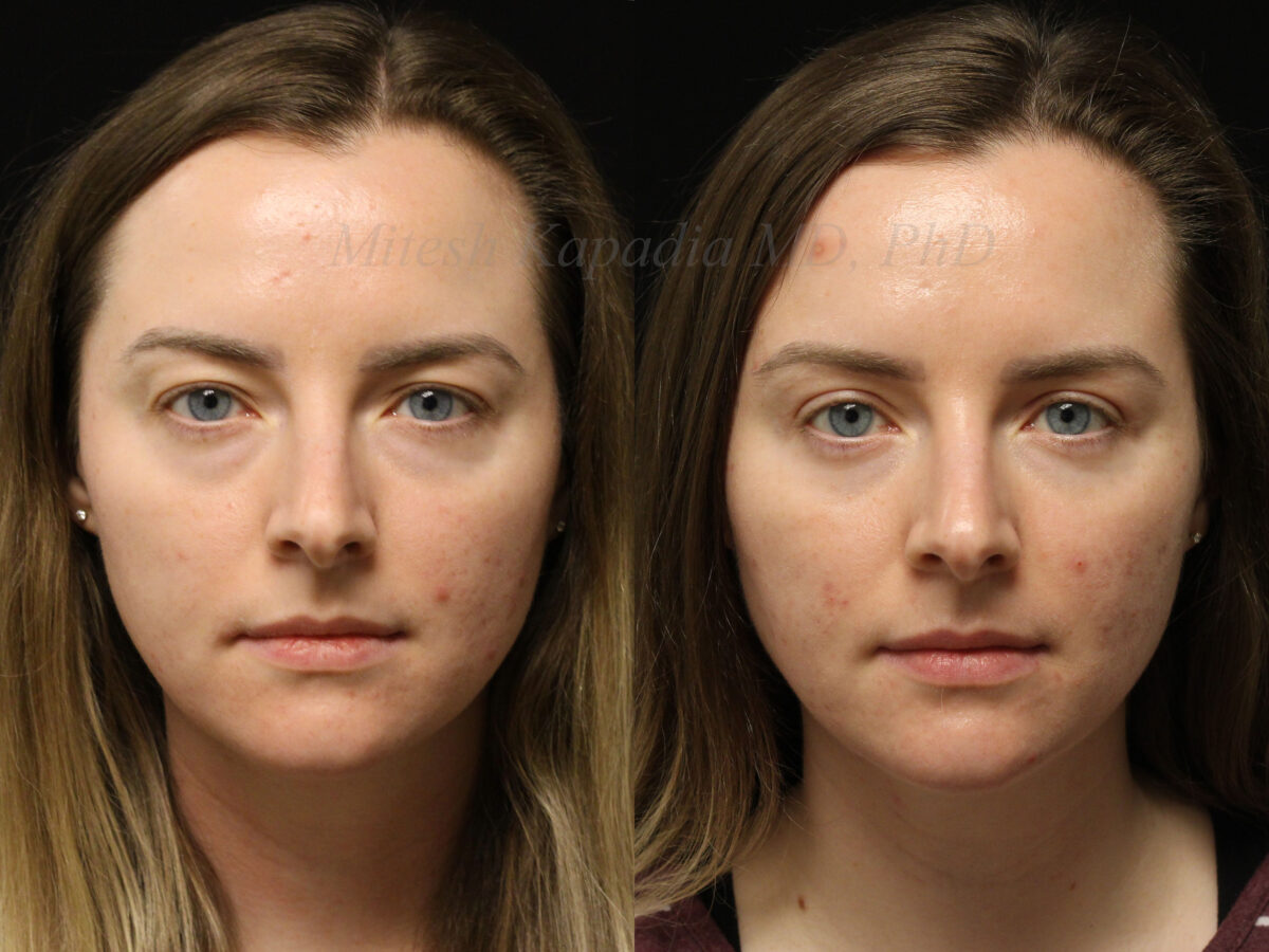 Before and 6 months after upper and lower blepharoplasty surgery ...