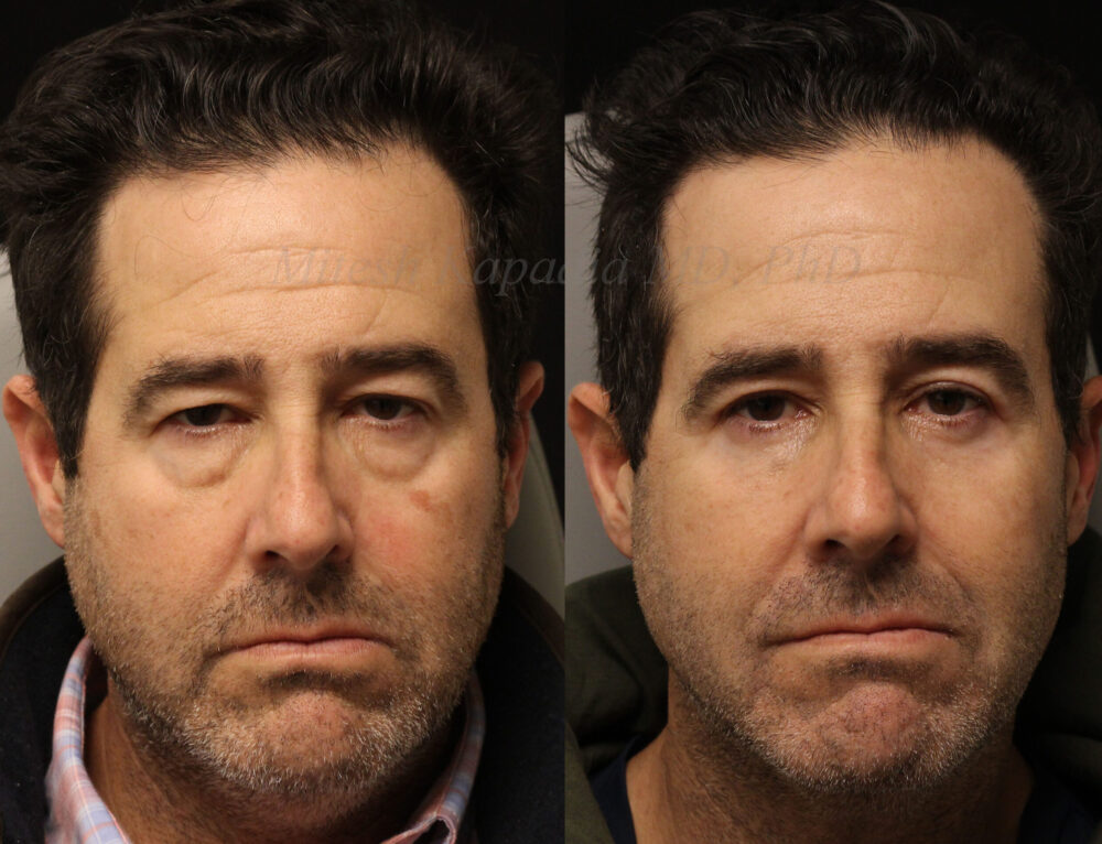 Before and two months after CO2 laser skin resurfacing | Boston Eyelid ...