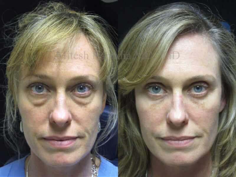 Surgery for Droopy Eyelids: Blepharoplasty, Brow Lift, and Ptosis ...